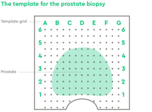 Prostate Biopsy | Diagnostics | Birmingham Prostate Clinic