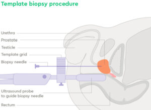 Prostate Biopsy | Diagnostics | Birmingham Prostate Clinic
