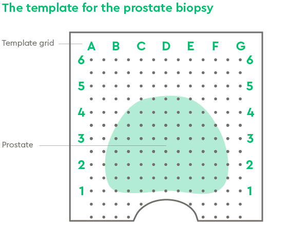 Prostate Biopsy Diagnostics Birmingham Prostate Clinic Prostate Biopsy Diagnostics Birmingham Prostate Clinic